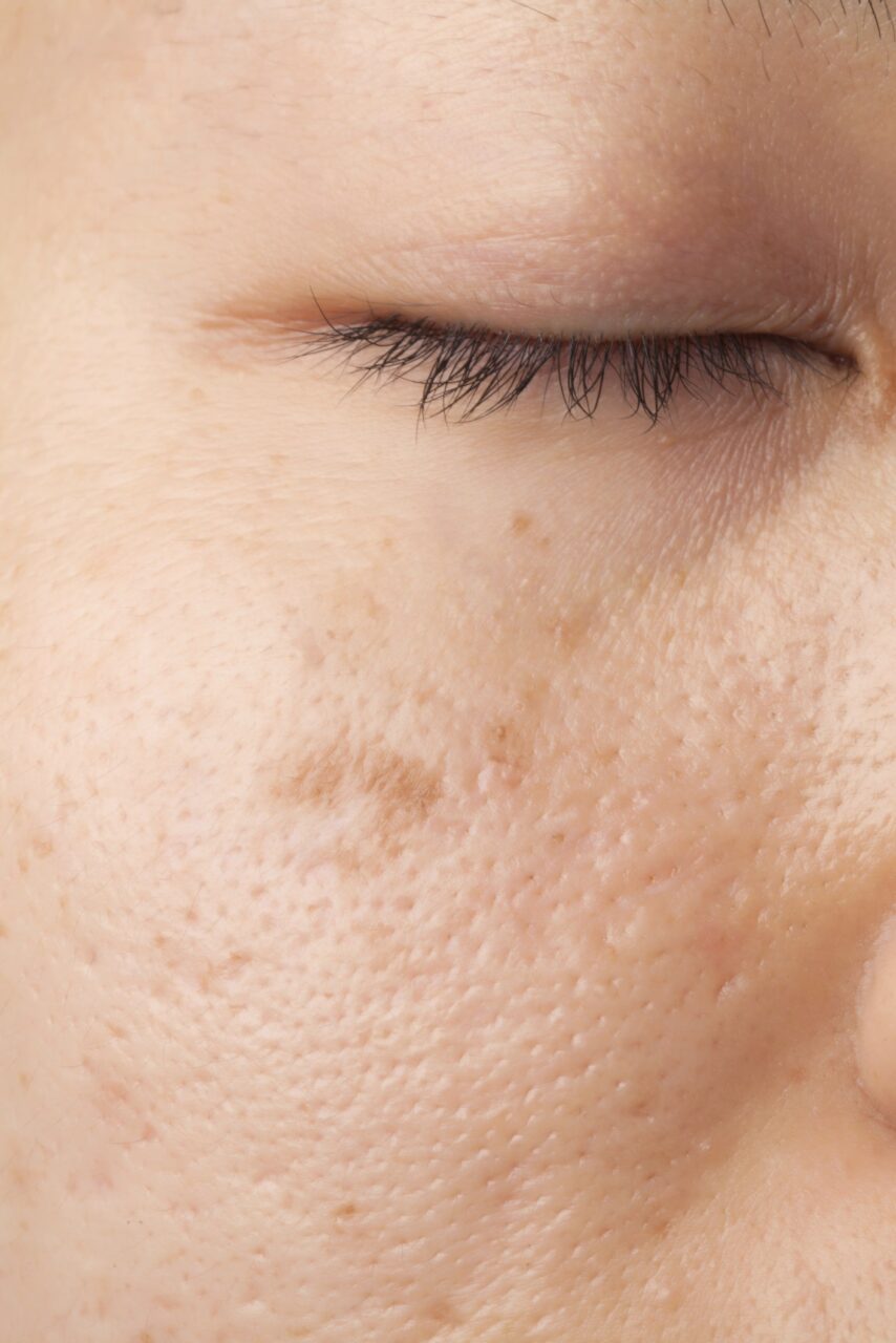 Will Removing Skin Lesions With a Laser Leave a Scar? Understanding ...