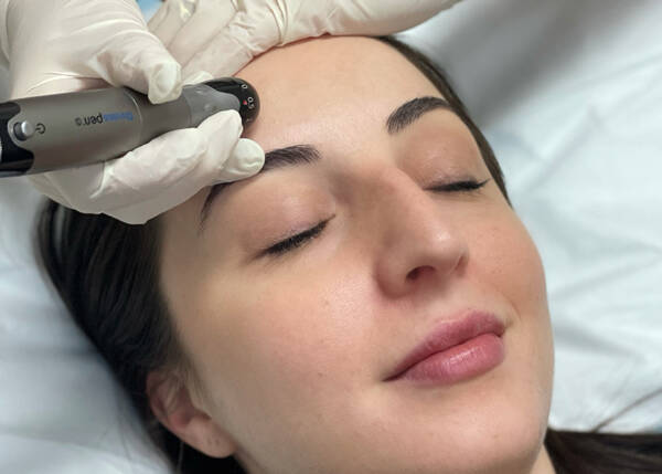 Skin Needling Adelaide - Laser Skin & Vein Clinic